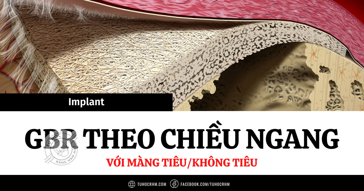 GBR theo chiều ngang với màng tiêu/không tiêu - Tự học RHM